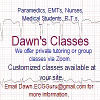 Atrial flutter with variable conduction | ECG Guru - Instructor Resources